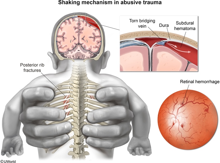 Neurologic Child abuse - PANCE Online Test Prep & Practice Exams ...